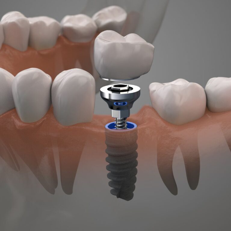 What Are Dental Implants? A Complete Guide to Permanent Tooth Root ...