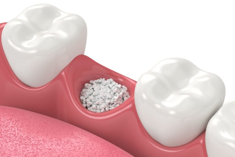 Everything You Should Know About Dental Bone Grafting