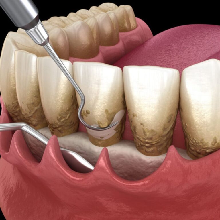 Osseous Surgery in Seattle, WA | Dental Specialties Northwest